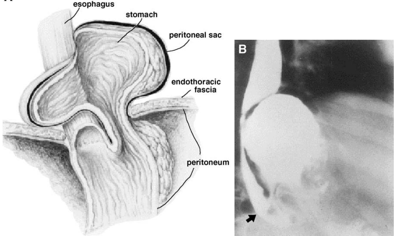 (a) illustration of true paraesophageal hernia (type ih).