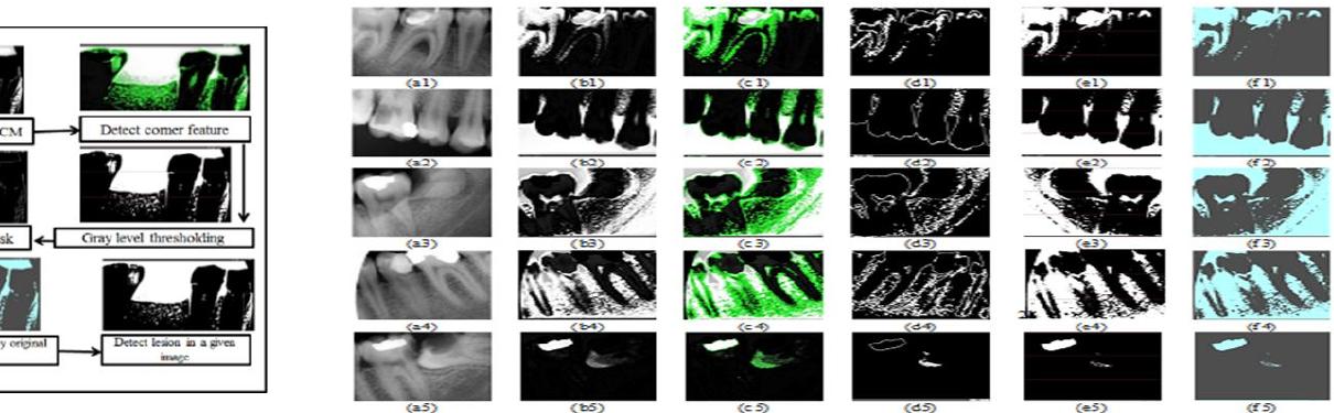 Block diagram of segmenting dental radiograph image using