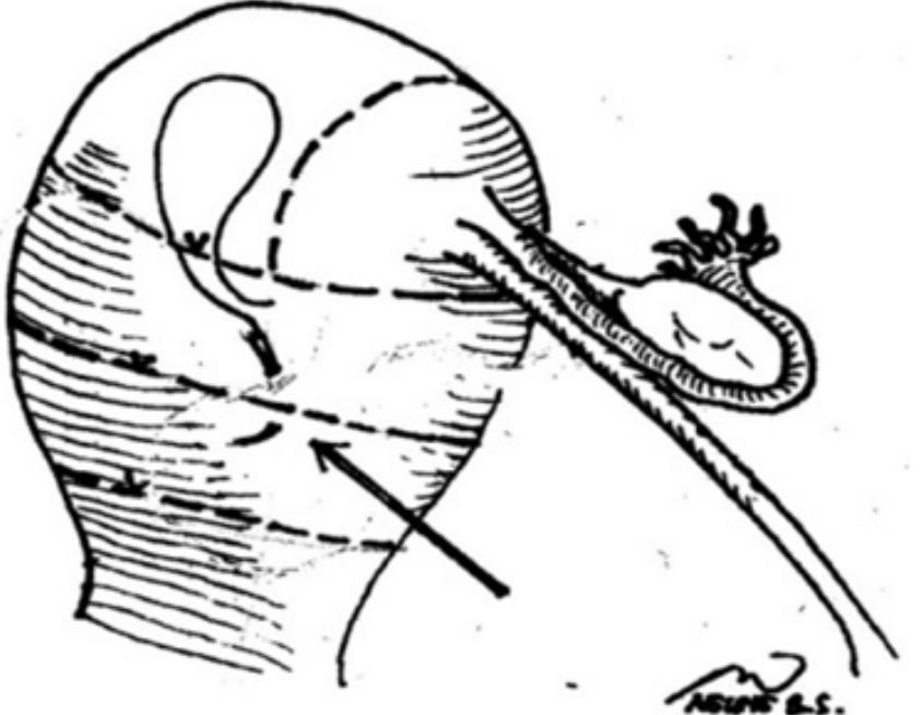 Three transverse circular sutures placed first, followed by