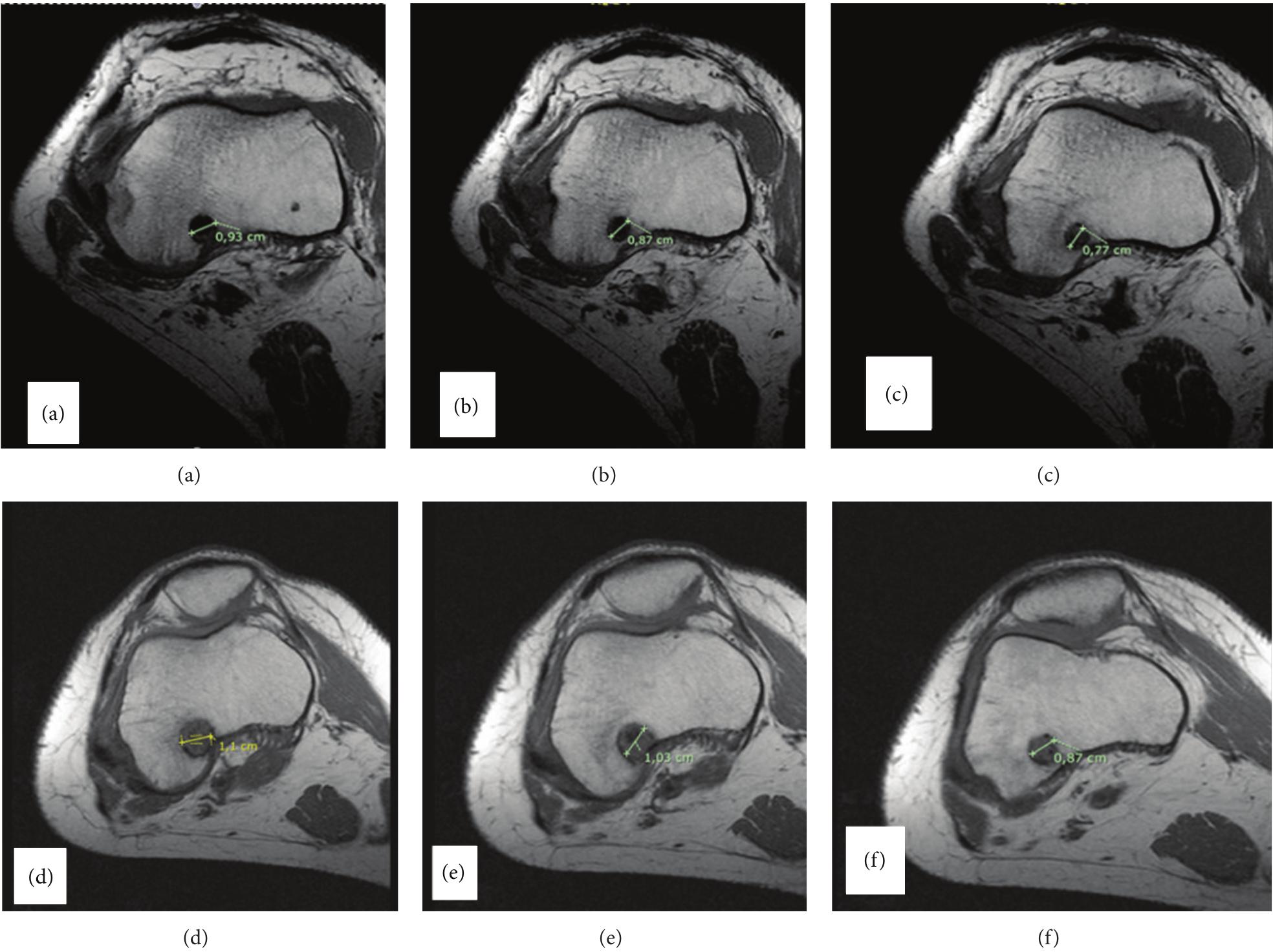 Ficure 4: comparison of femoral tunnel’s axial mri cuts