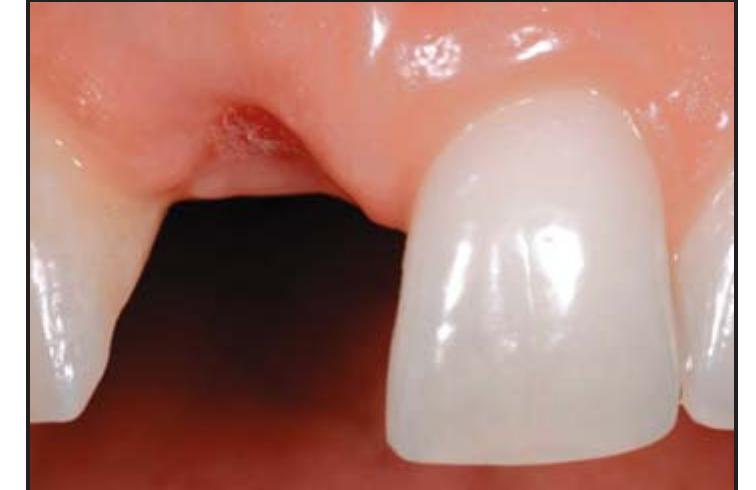 (PDF) A simplified socket classification and repair technique