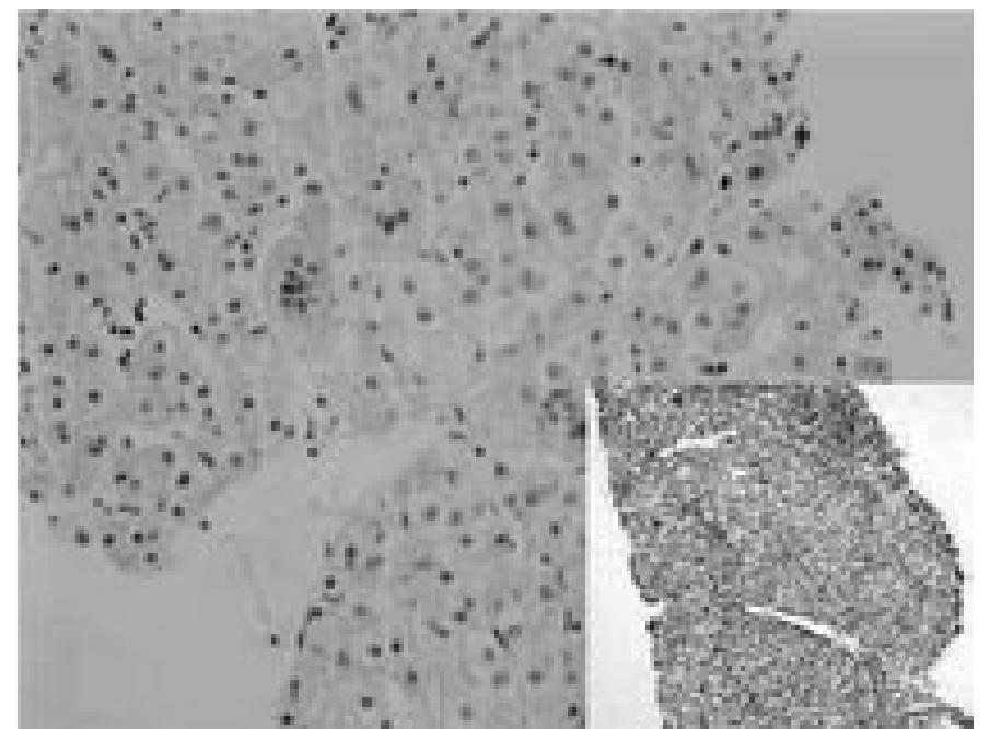 Liver biopsy at the age of 6 months: note mild fibrosis and