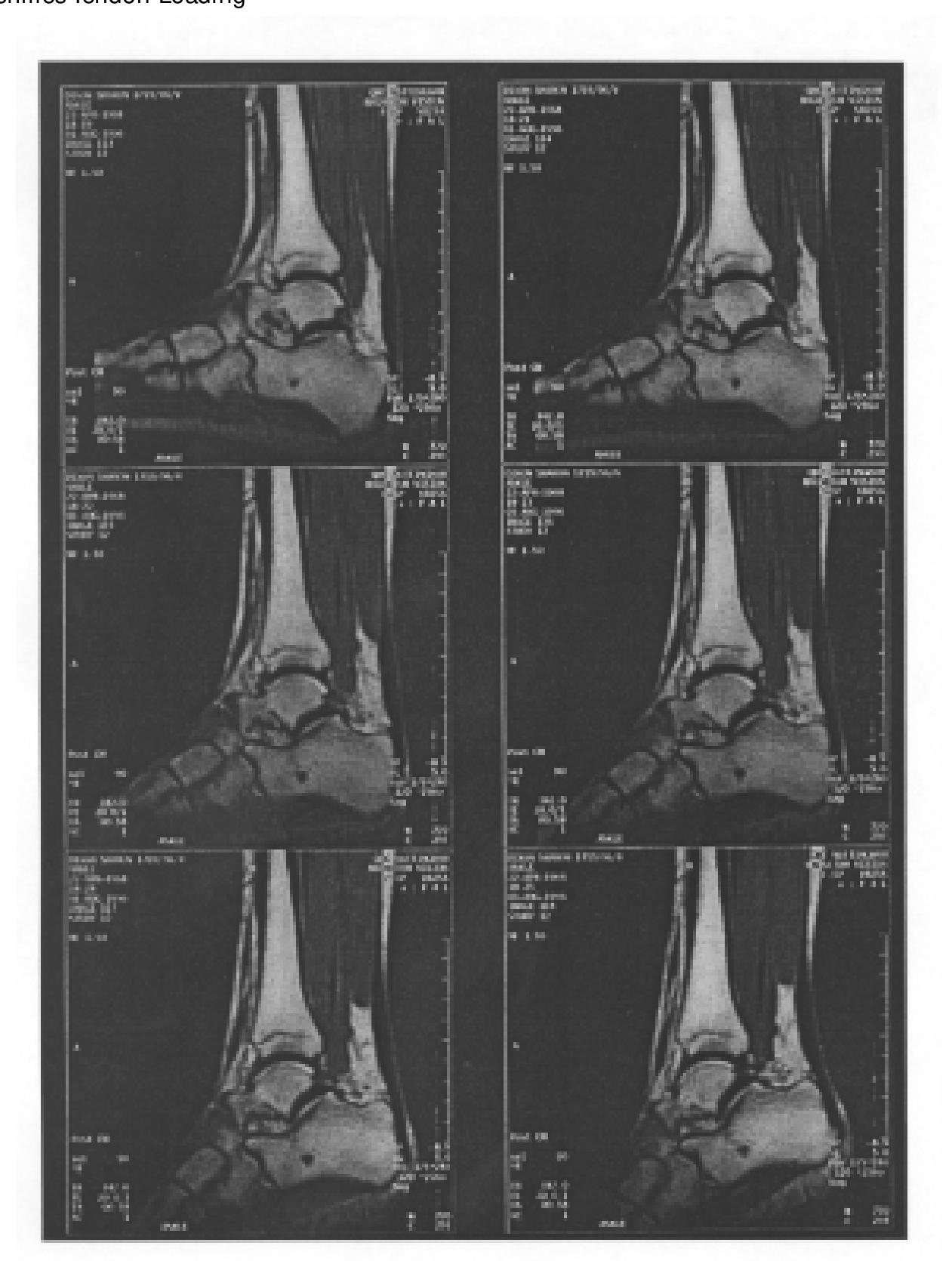 sagittal-plane mri images through the midline of the ankle
