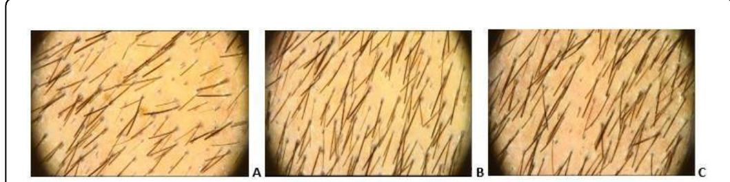 Phototrichogram images for one patient at baseline, d92 and