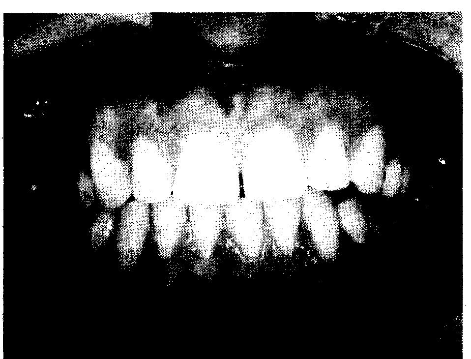 One millimeter of mandibular lateral movement from