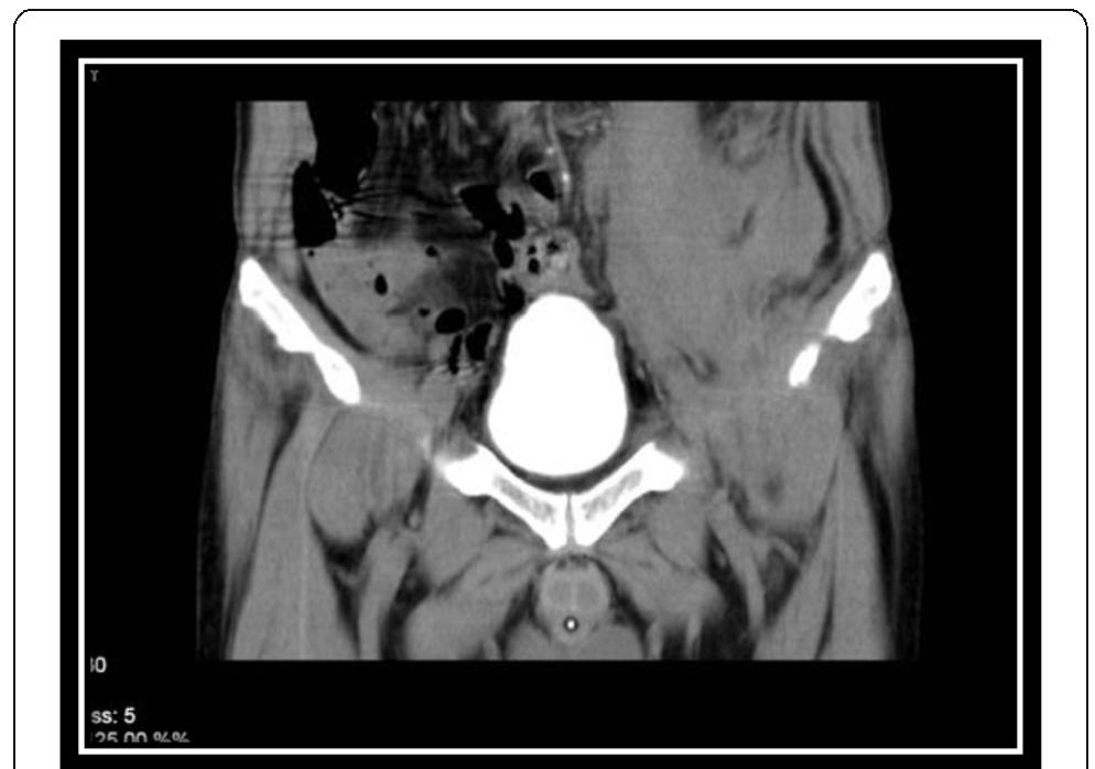 Ct cystography (coronal view) the pathogenesis of the may be
