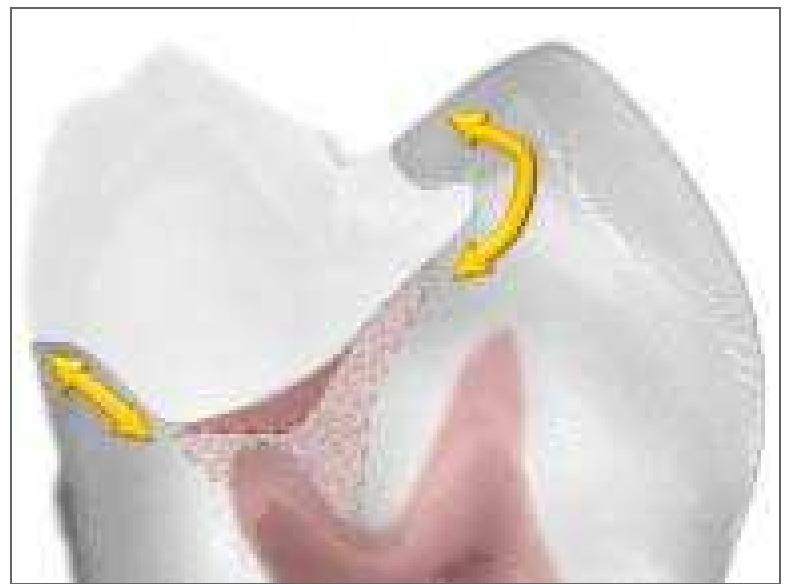 Caries removal end points for a deep lesion. the peripheral