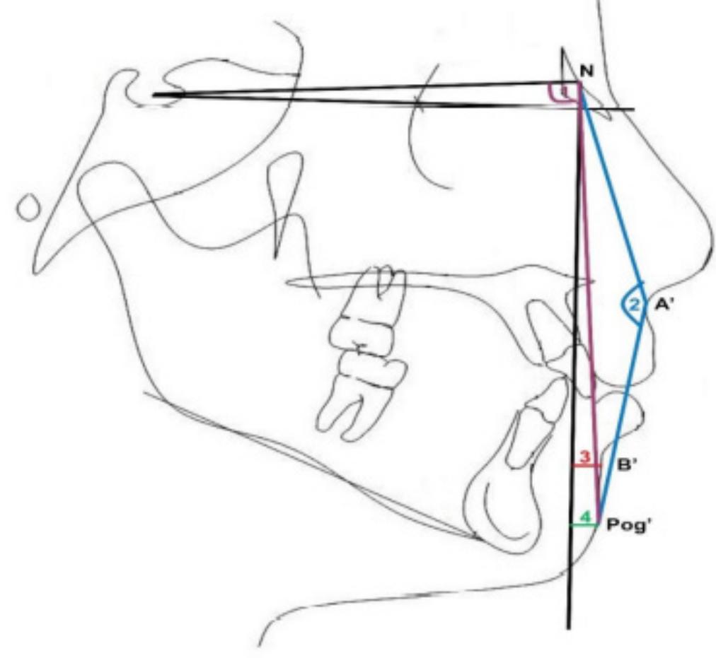 Cephalometric soft tissue measurements; 1: sn-pog’, 2: angle