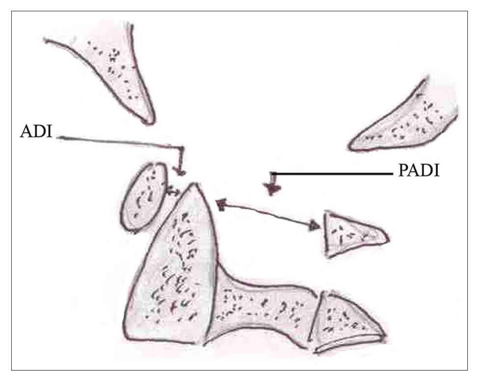 A: a line diagram showing normal cranio-cervical junction