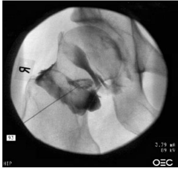 (PDF) Hip Joint Pain Referral Patterns: A Descriptive Study