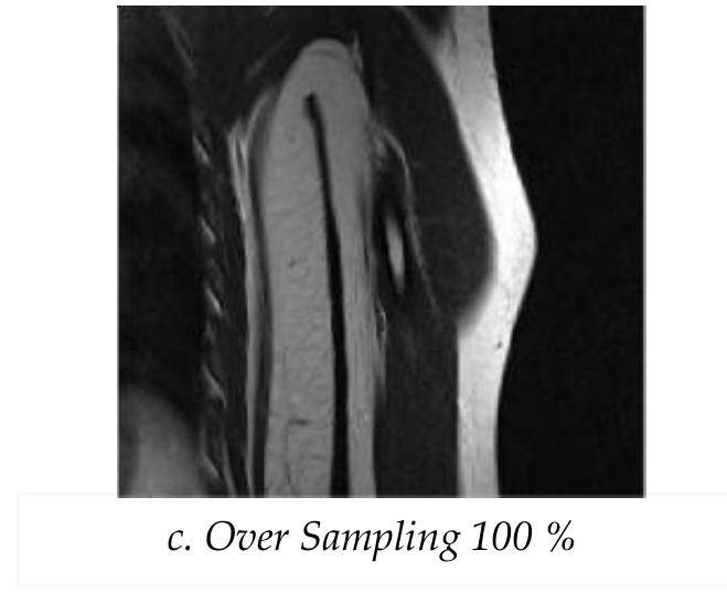 Figure 3 - Artefak Aliasing Citra Mri Humerus Menggunakan