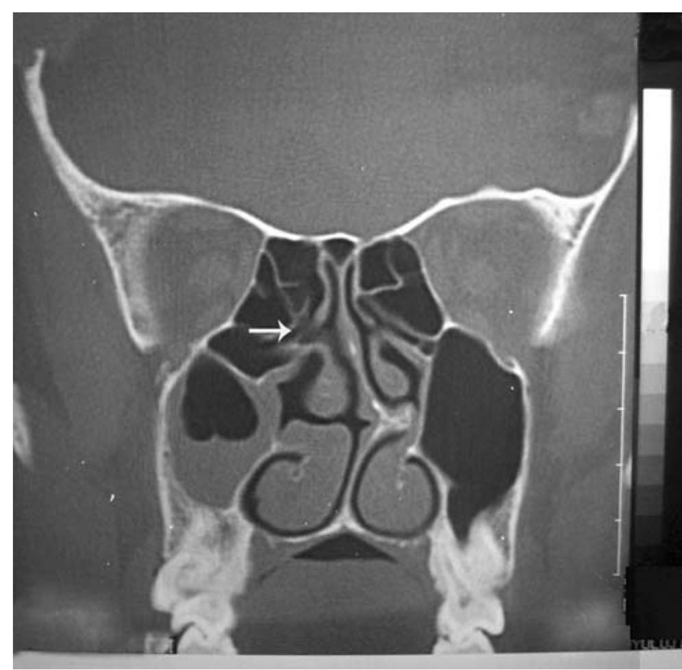 (PDF) Ethmomaxillary sinus
