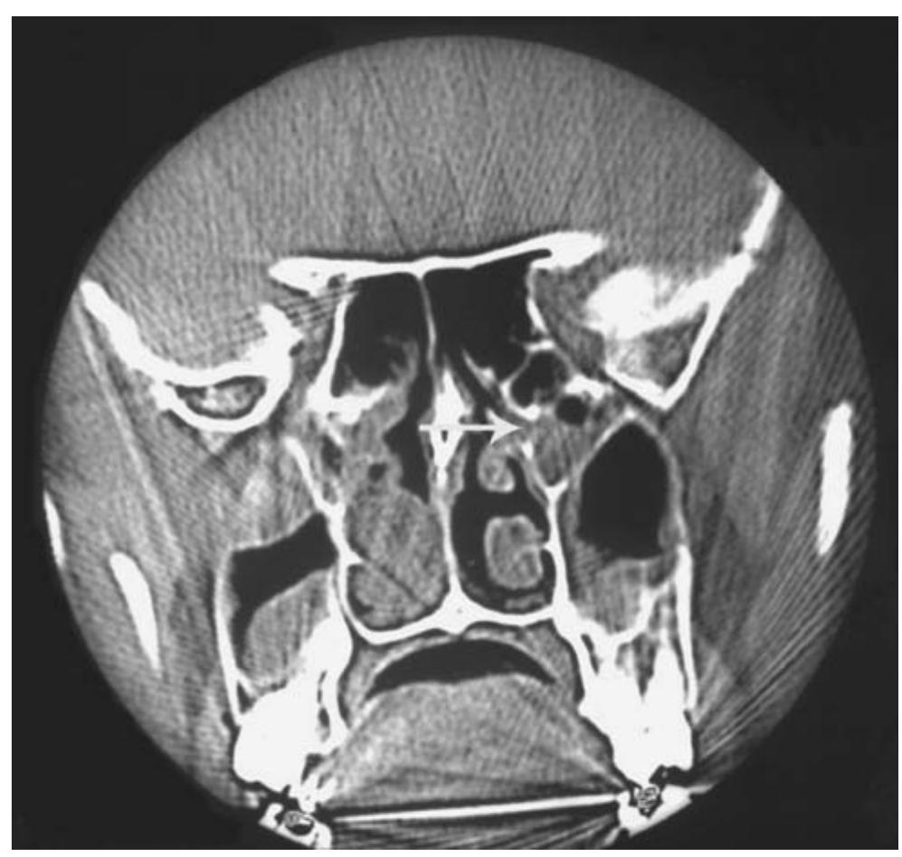 (PDF) Ethmomaxillary sinus