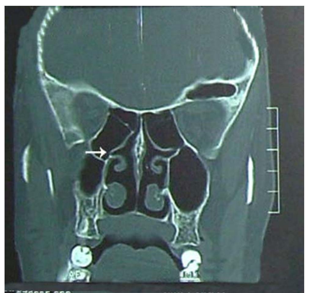 (PDF) Ethmomaxillary sinus