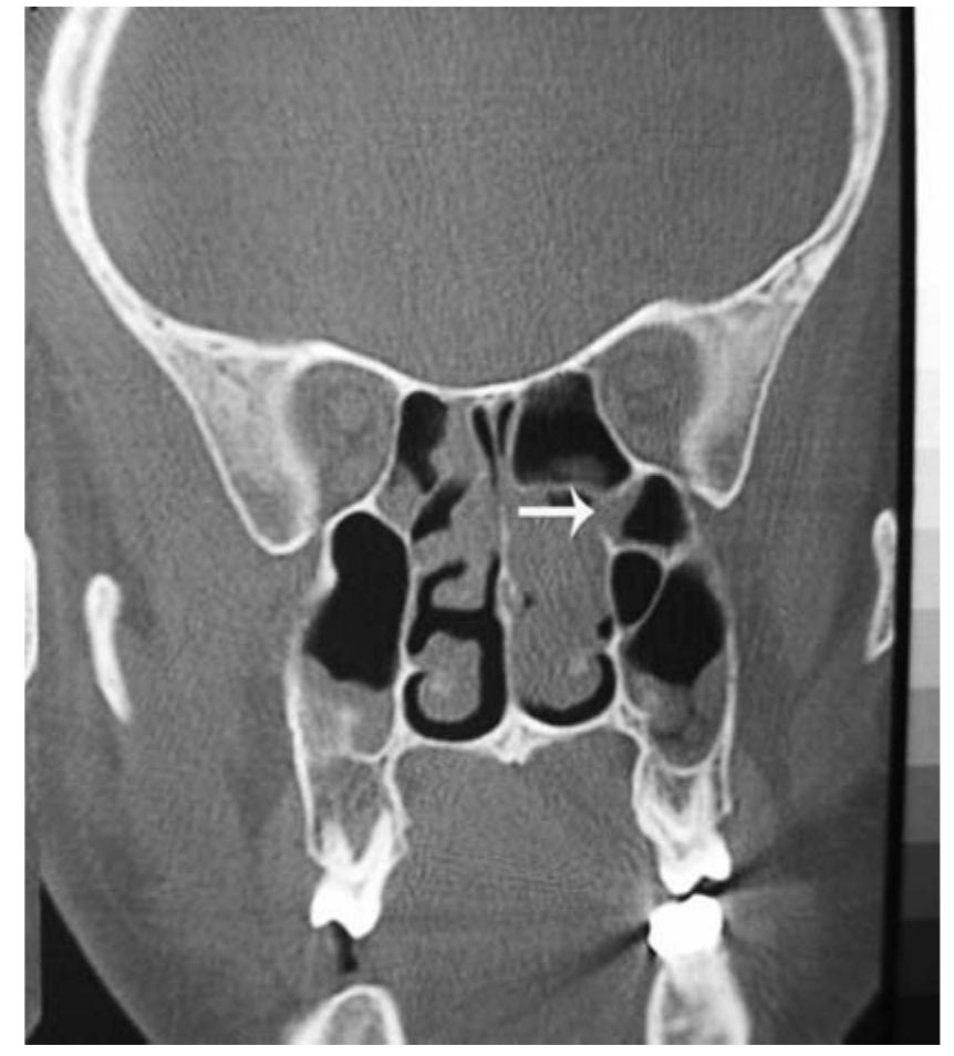 (PDF) Ethmomaxillary sinus