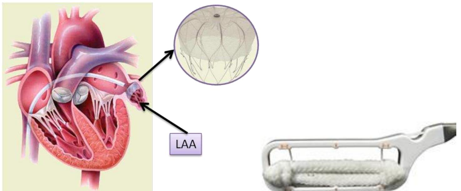 The watchman® left atrial appendage filter system (left);