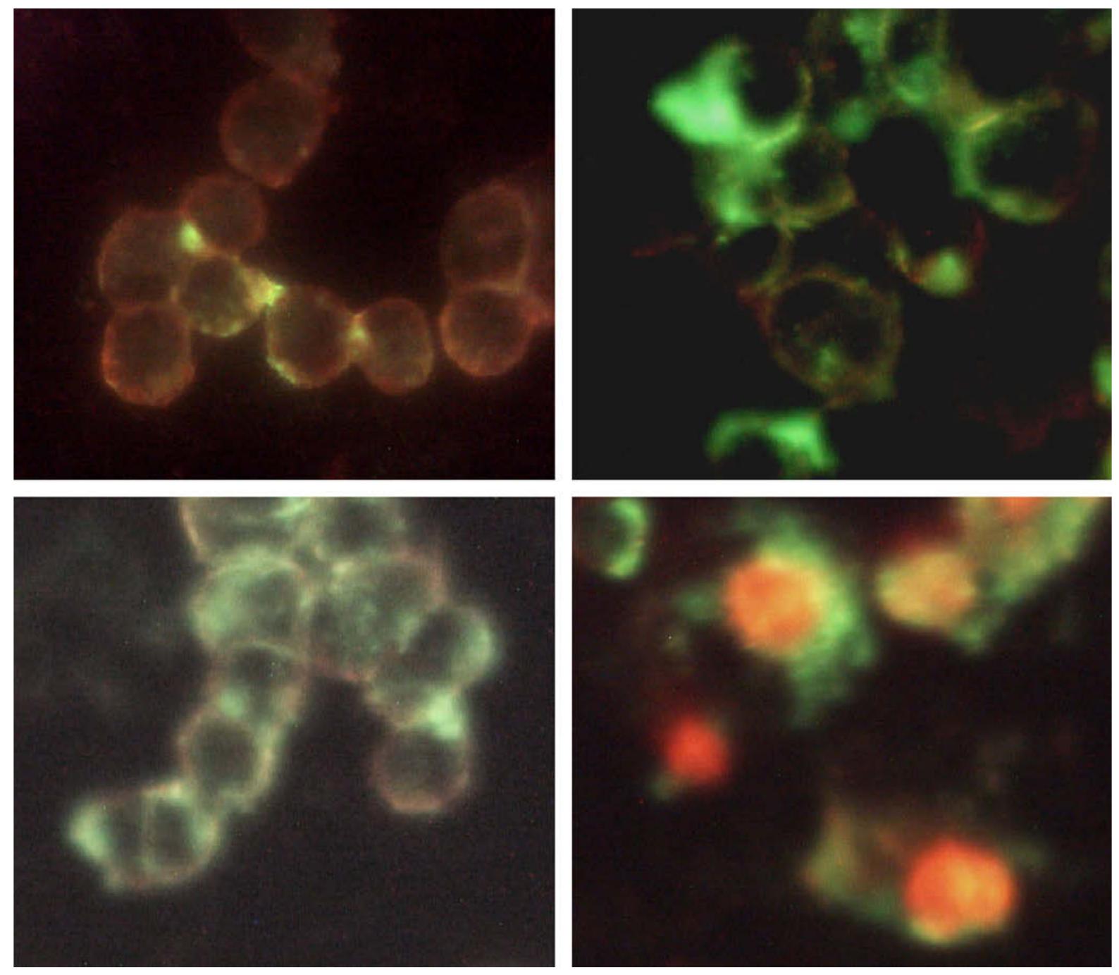Microscope images of apoptotic and necrotic cells in tumor