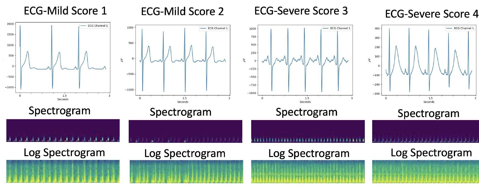 Examples of ecg waveforms collected from tetanus patients,