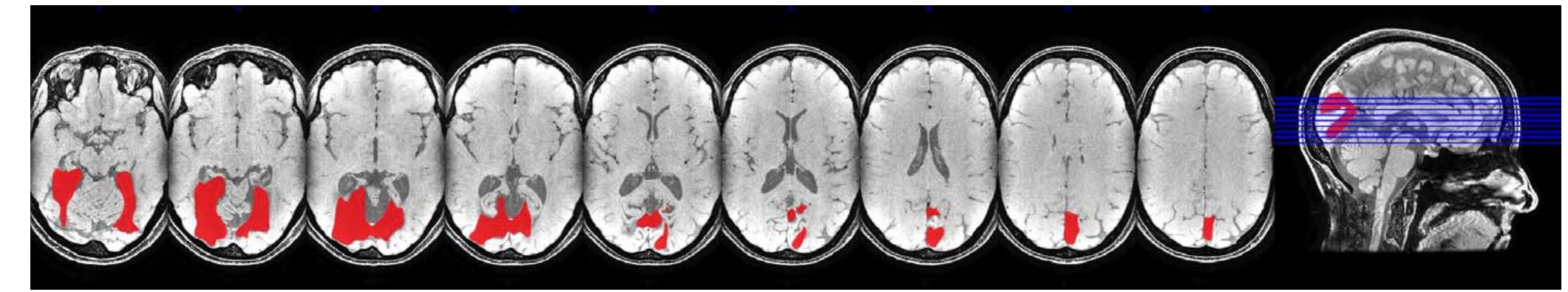 Figure 1 - from The locus of color sensation: Cortical color
