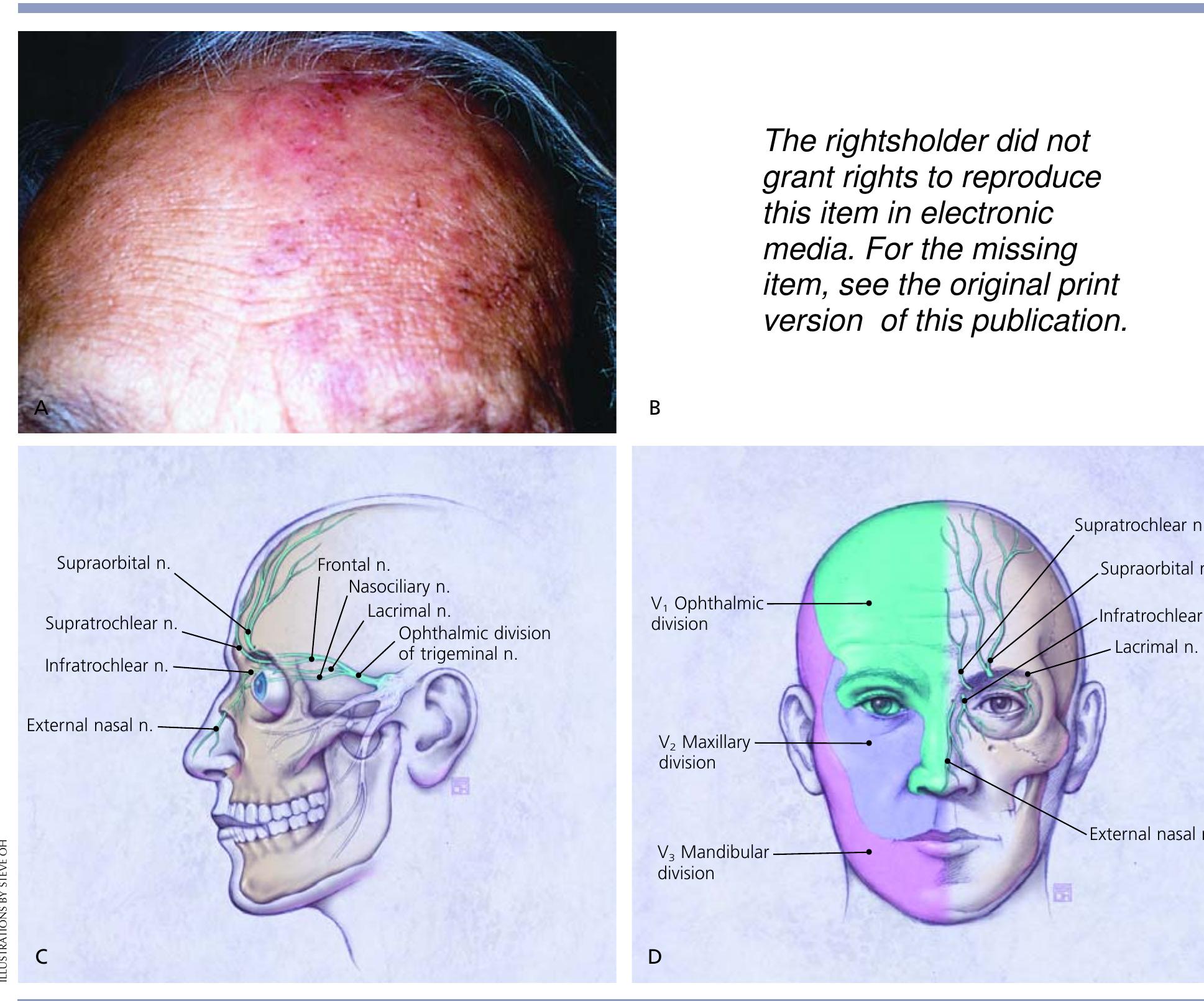 The hallmark of herpes zoster ophthalmicus is a vesicular