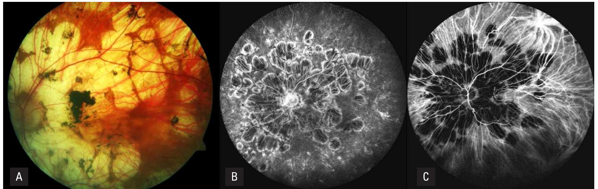 Patient 2. the left eye: extensive chorioretinal scars with