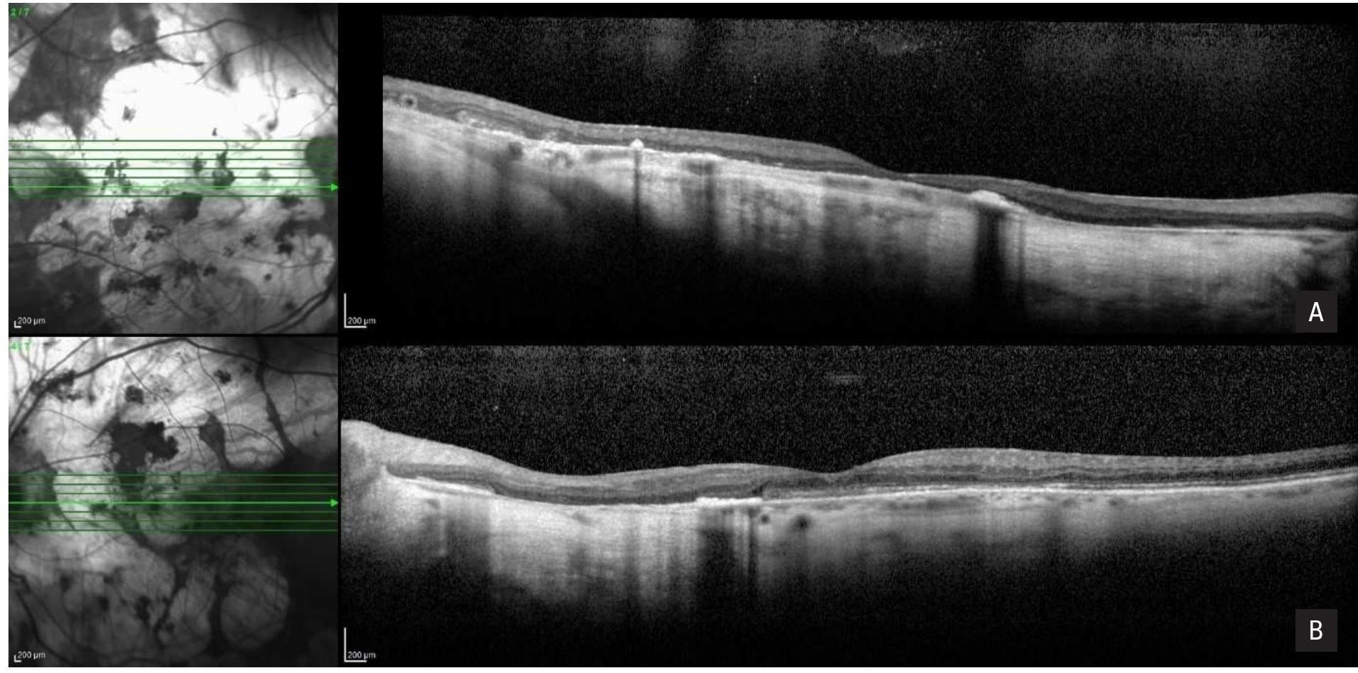 Patient 2: optical coherence tomography (oct) scans of the