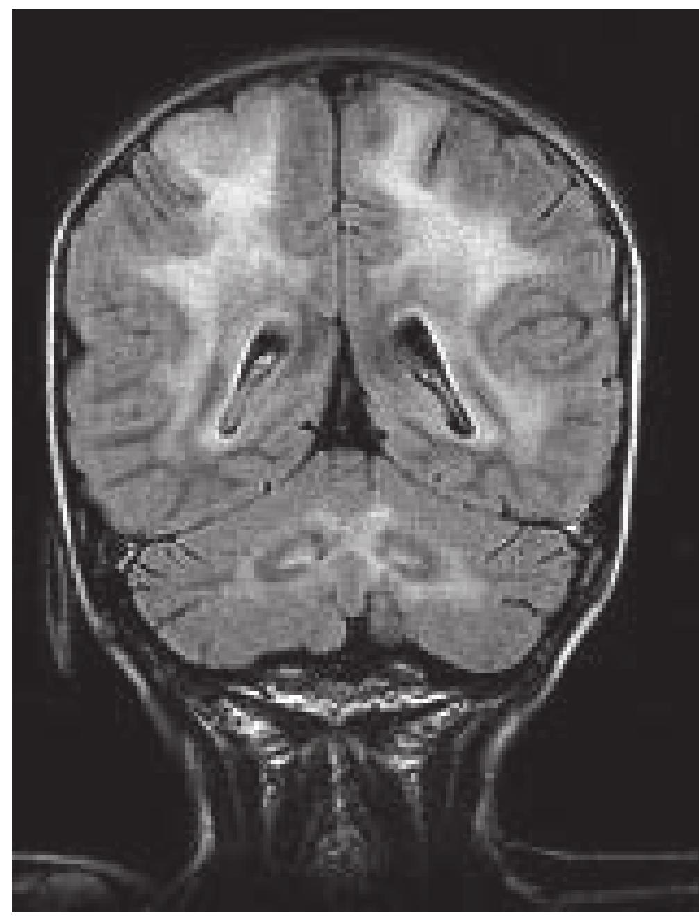 Mri of patient 6 with juvenile form. lesions in the hili of