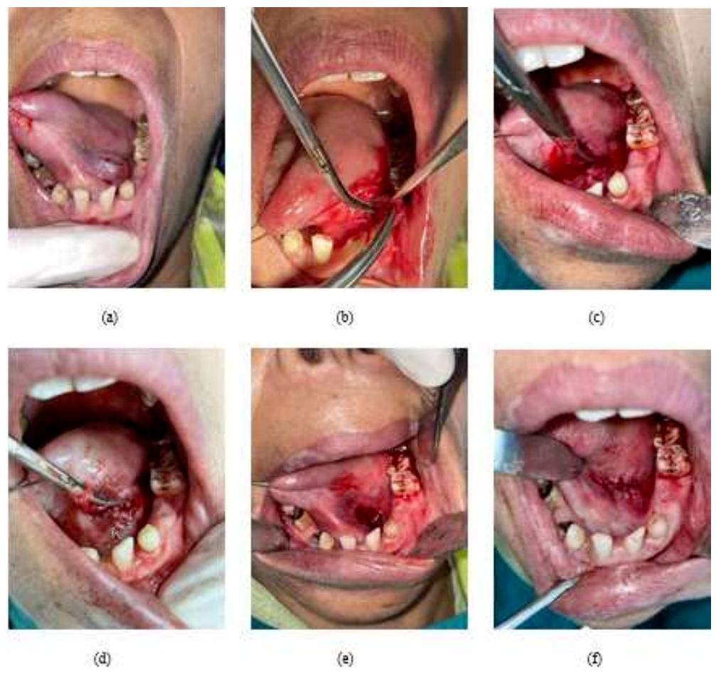 Figures a, b, c, d, e, f depicts the procedure of surgical