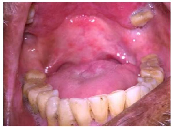 Figure 2 - from Oral erythroplakia – A case report