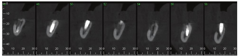 Computed tomography (cone beam) of the right mandible.