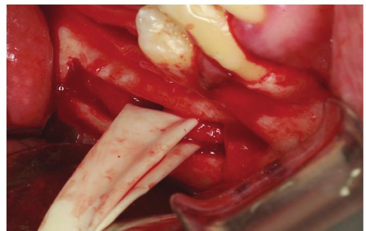 Figure 33 - Lateralization Technique and Inferior Alveolar