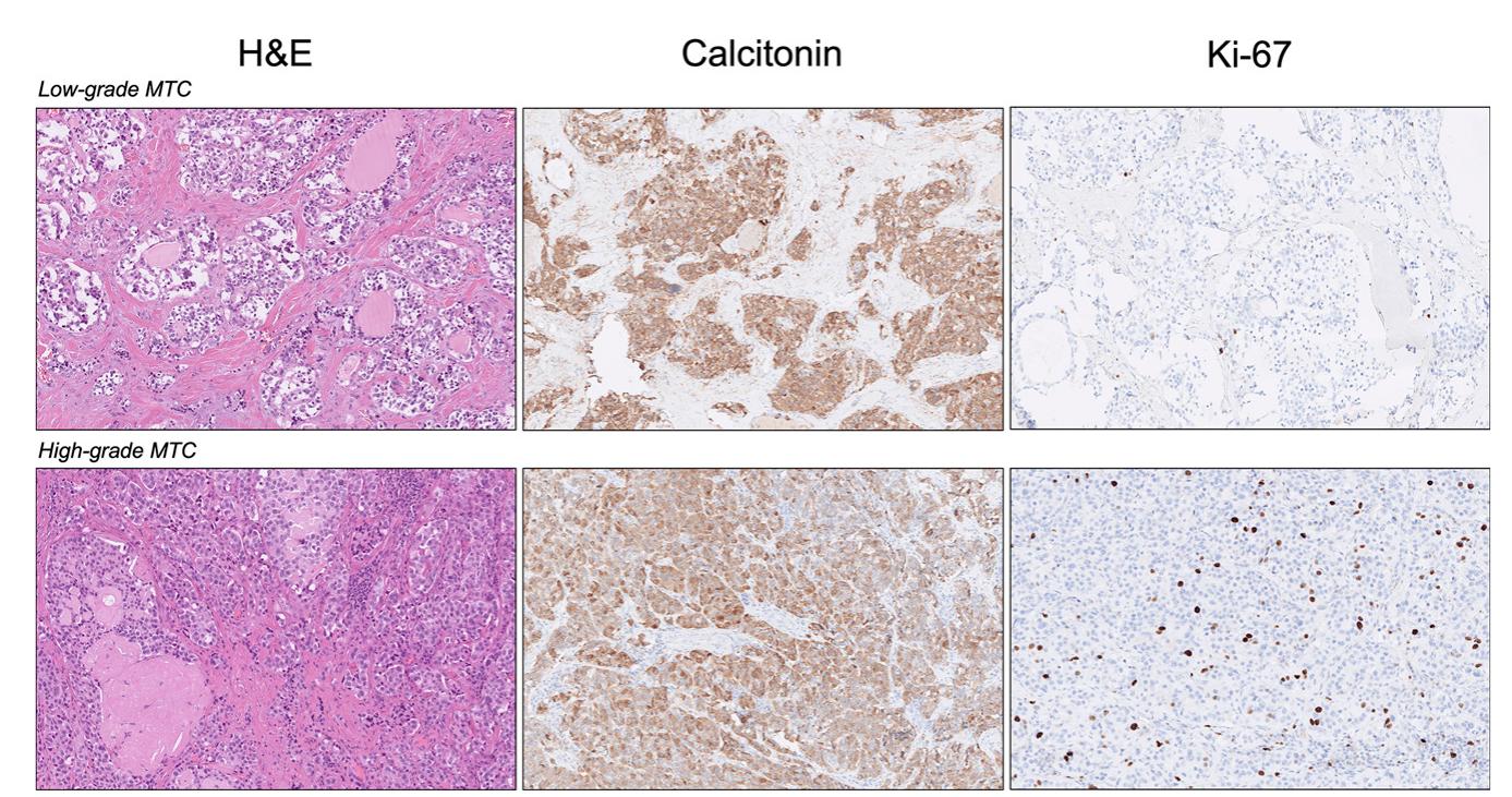 Figure 4 - The 2022 WHO classification of thyroid tumors:
