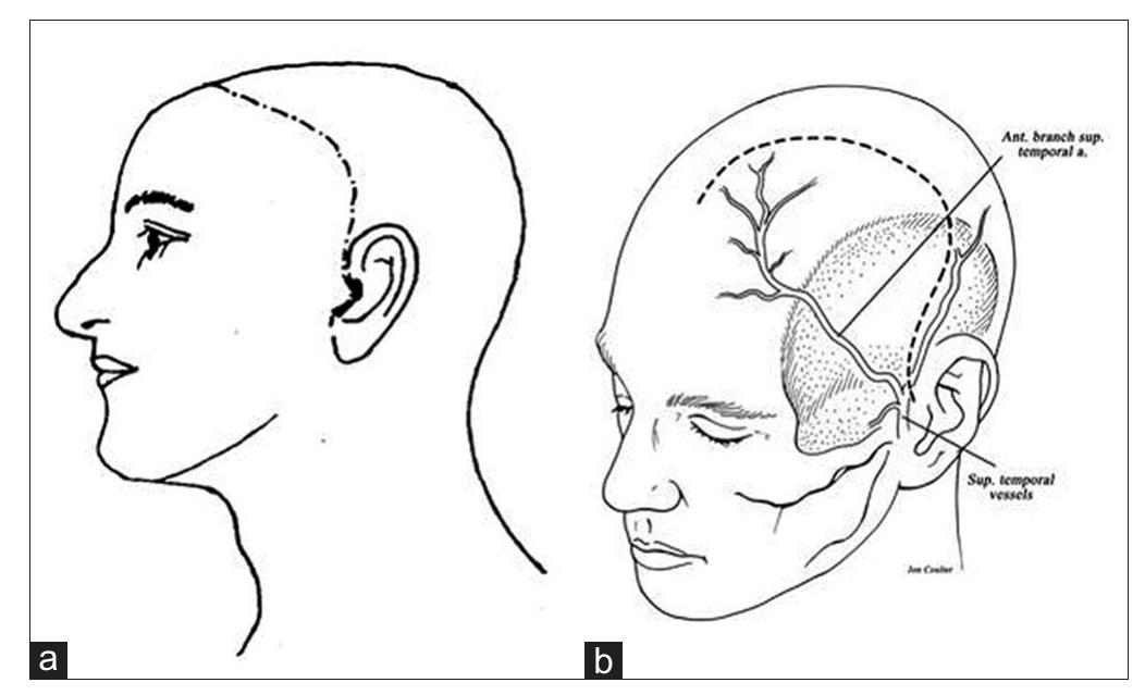 Line diagram of hemicoronal incision. (a) incision with
