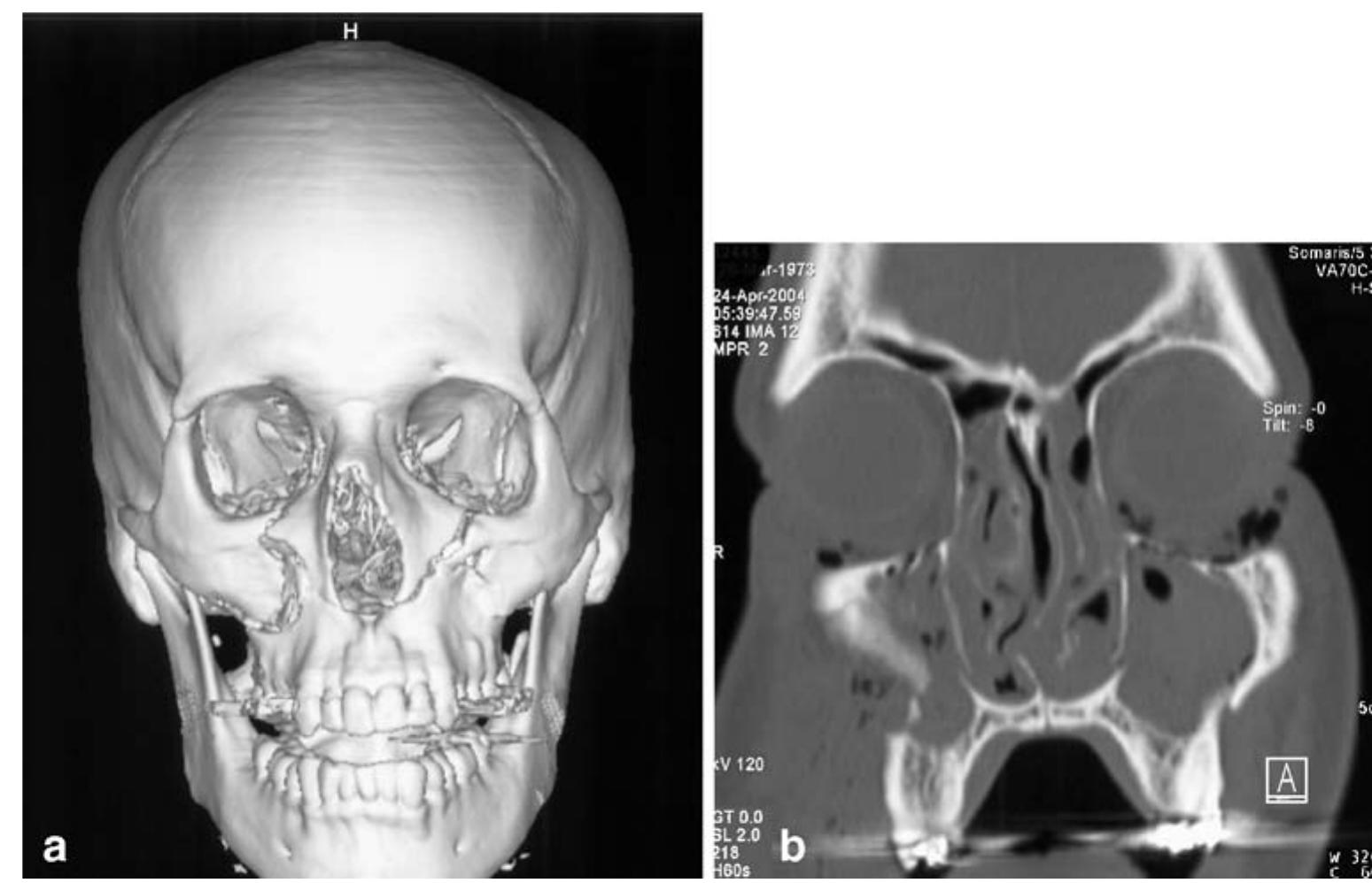 Lefort i fractures result in dislocation of the tooth baring