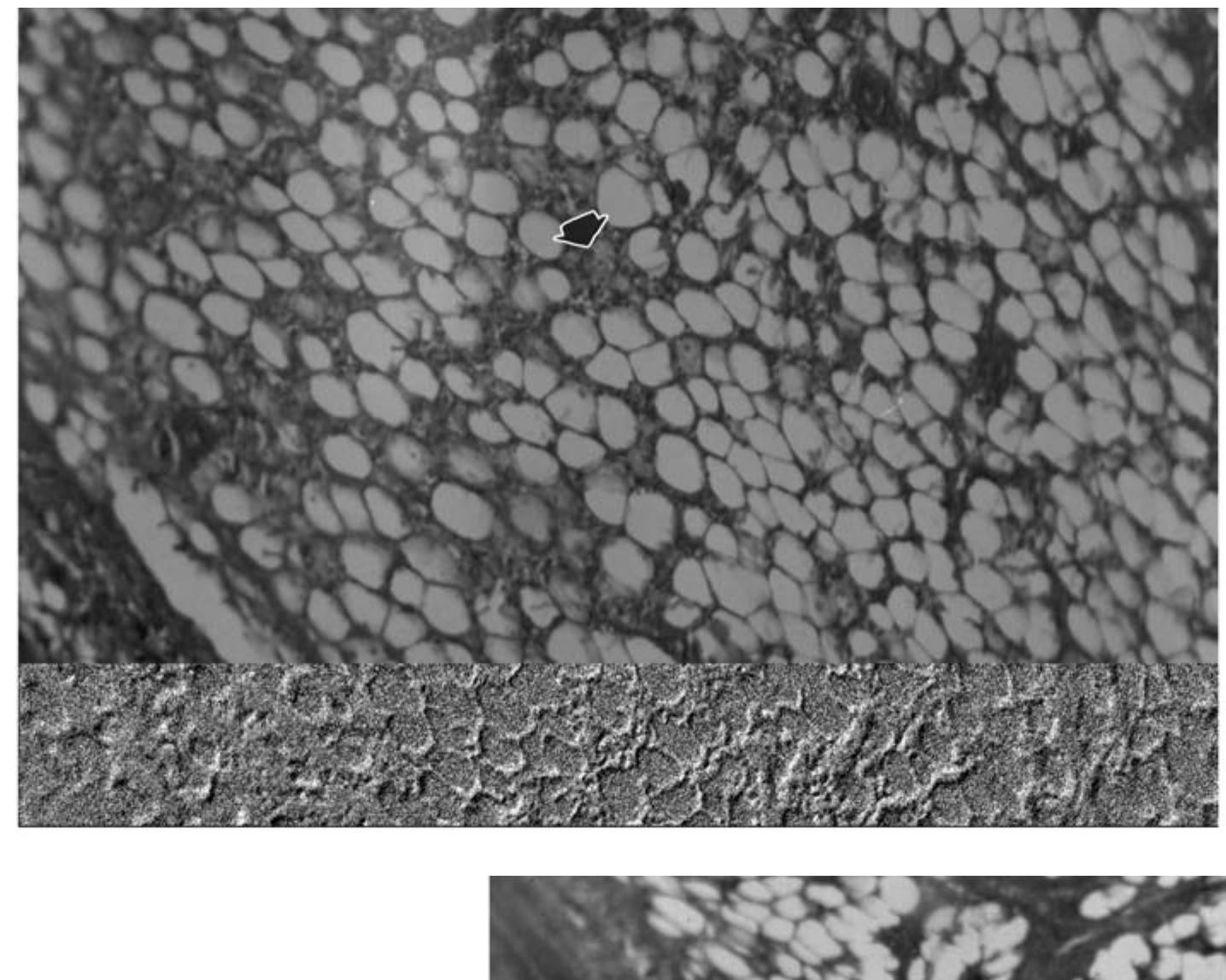 Mature adipose tissue with fibrosis tracts surroundig bone