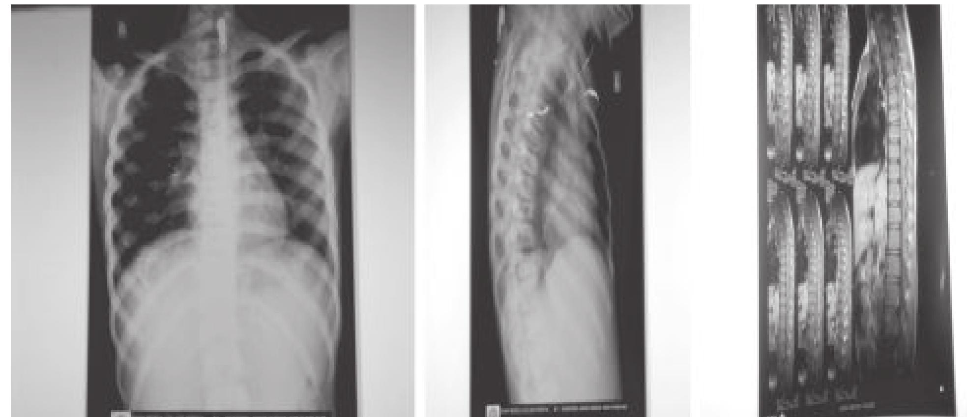 ,2,3: cxr , dorsolumber vertebrae and mri on 1° mri of