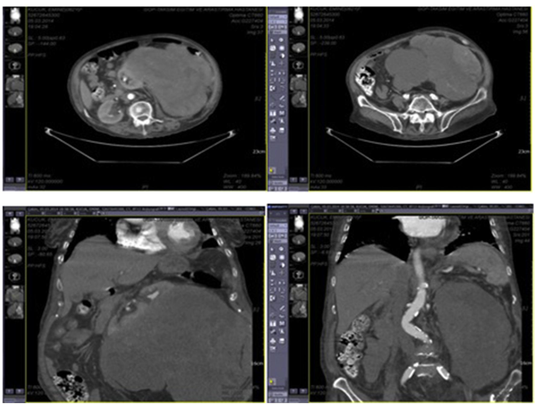 Ct scan of the left kidney mass.