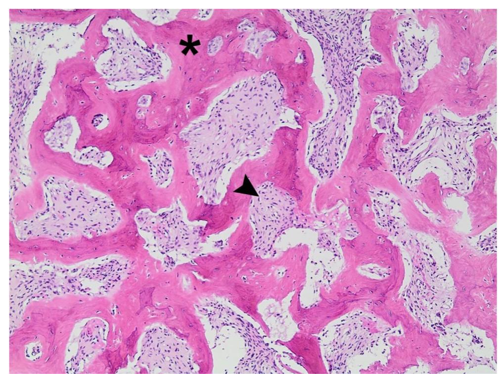 Histologic sections of right proximal tibia show dense