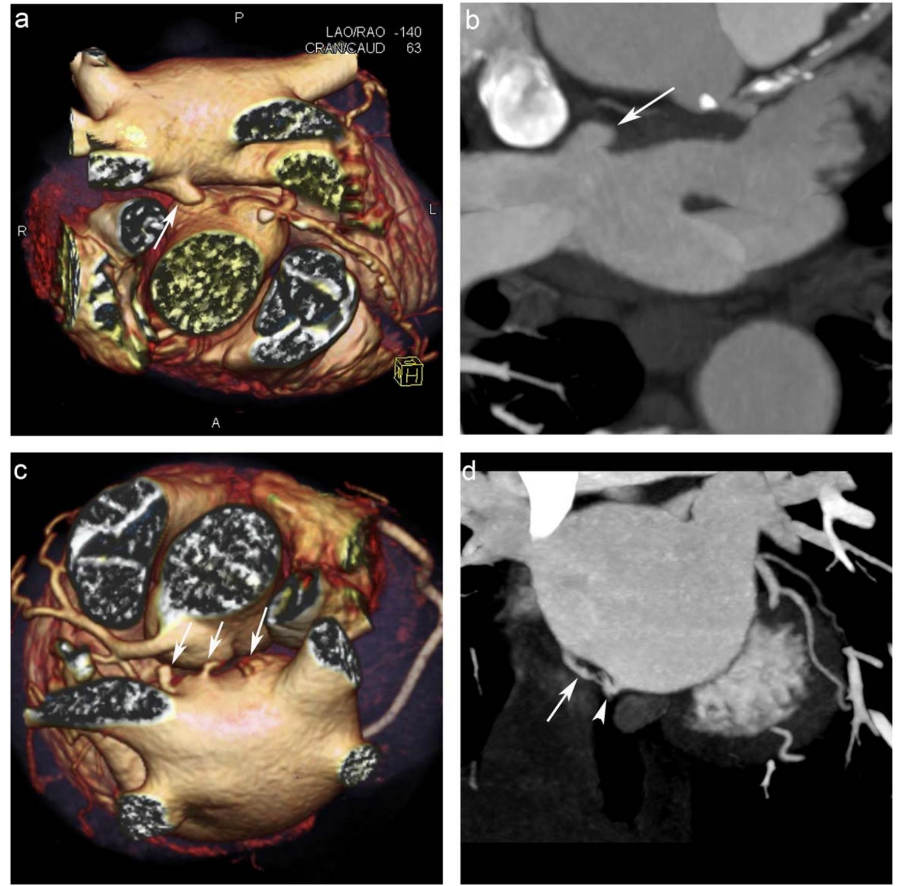 Anterior wall (arrows). a coronal mip (d) image of a differ-