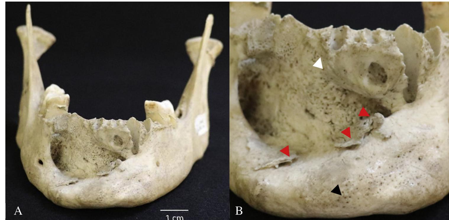 A. anterior view of em424 where an osteolytic lesion is