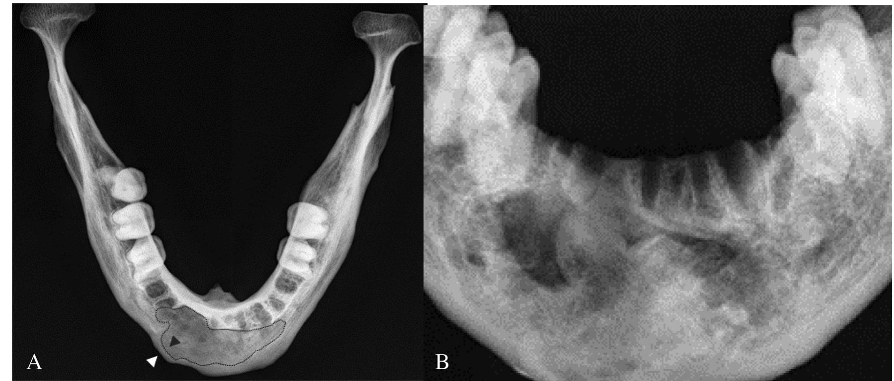 (a) image showing the multilocular morphology of the lesion