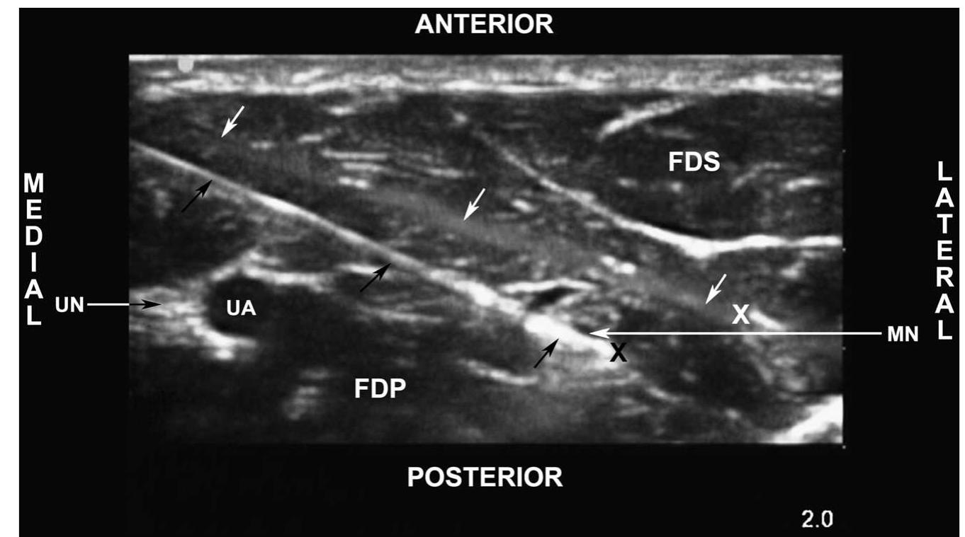 Ultrasound-guided median nerve block in the forearm. fdp