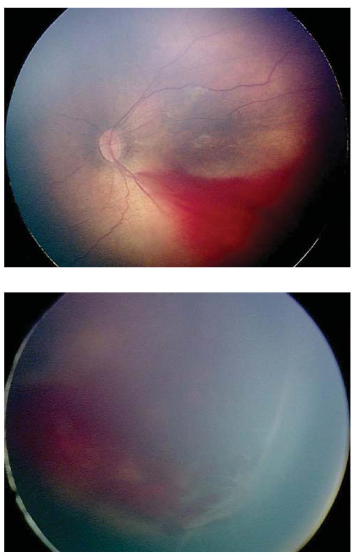 Representative color fundus photograph of a patient (case 6)