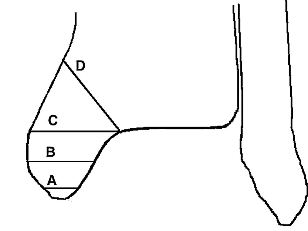 Isolated medial malleolar fracture classification by