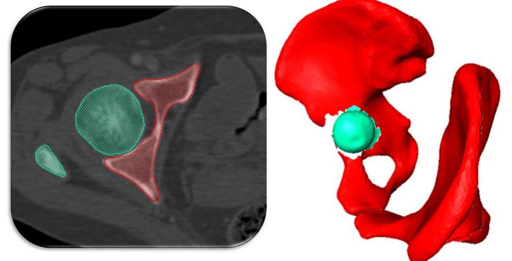 The segmented models of pelvis (red) and left proximal femur