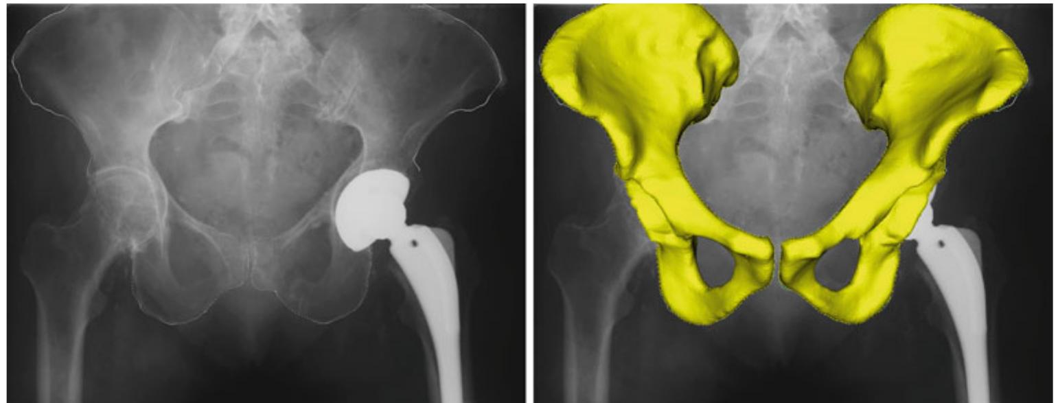 Shape model to the x-ray radiograph. for visual
