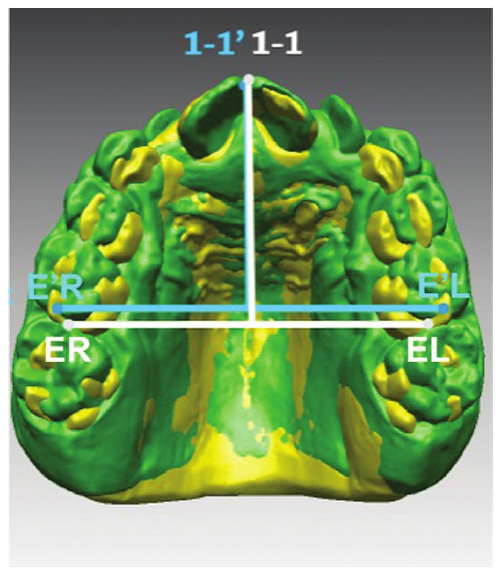T1-t2 digital models superimposed. homologous points placed