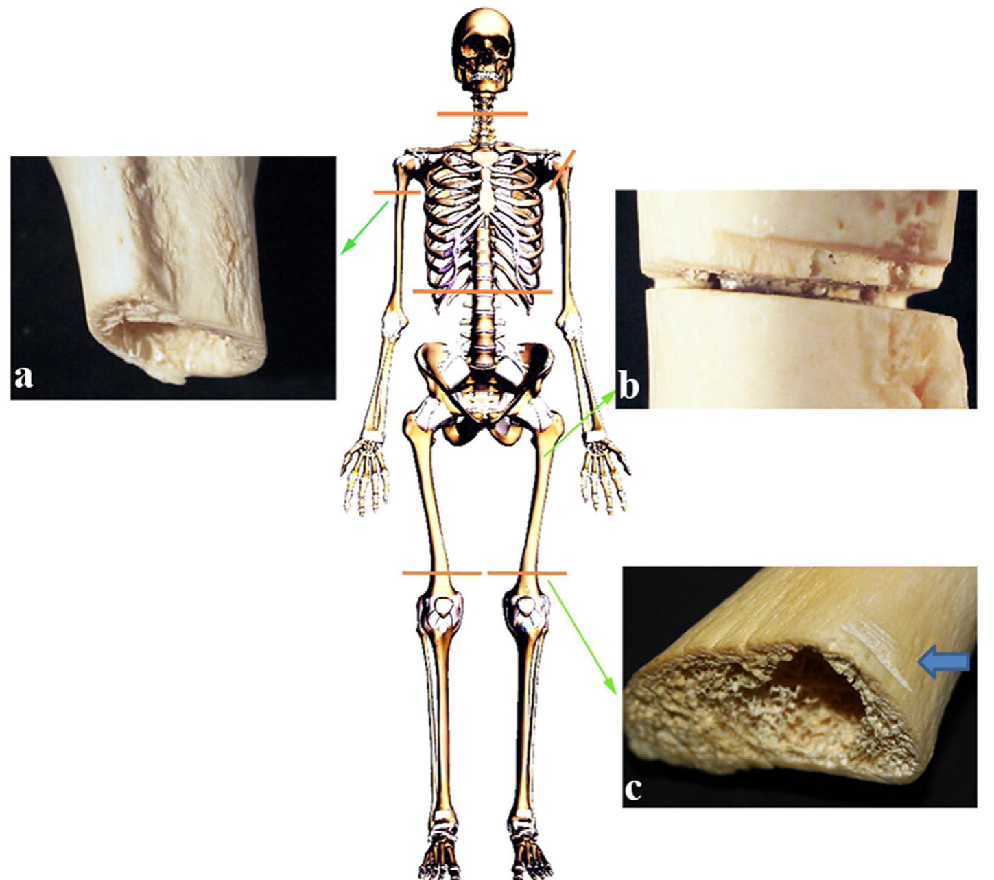 Case 1 — a) severed proximal epiphysis of the right humerus;