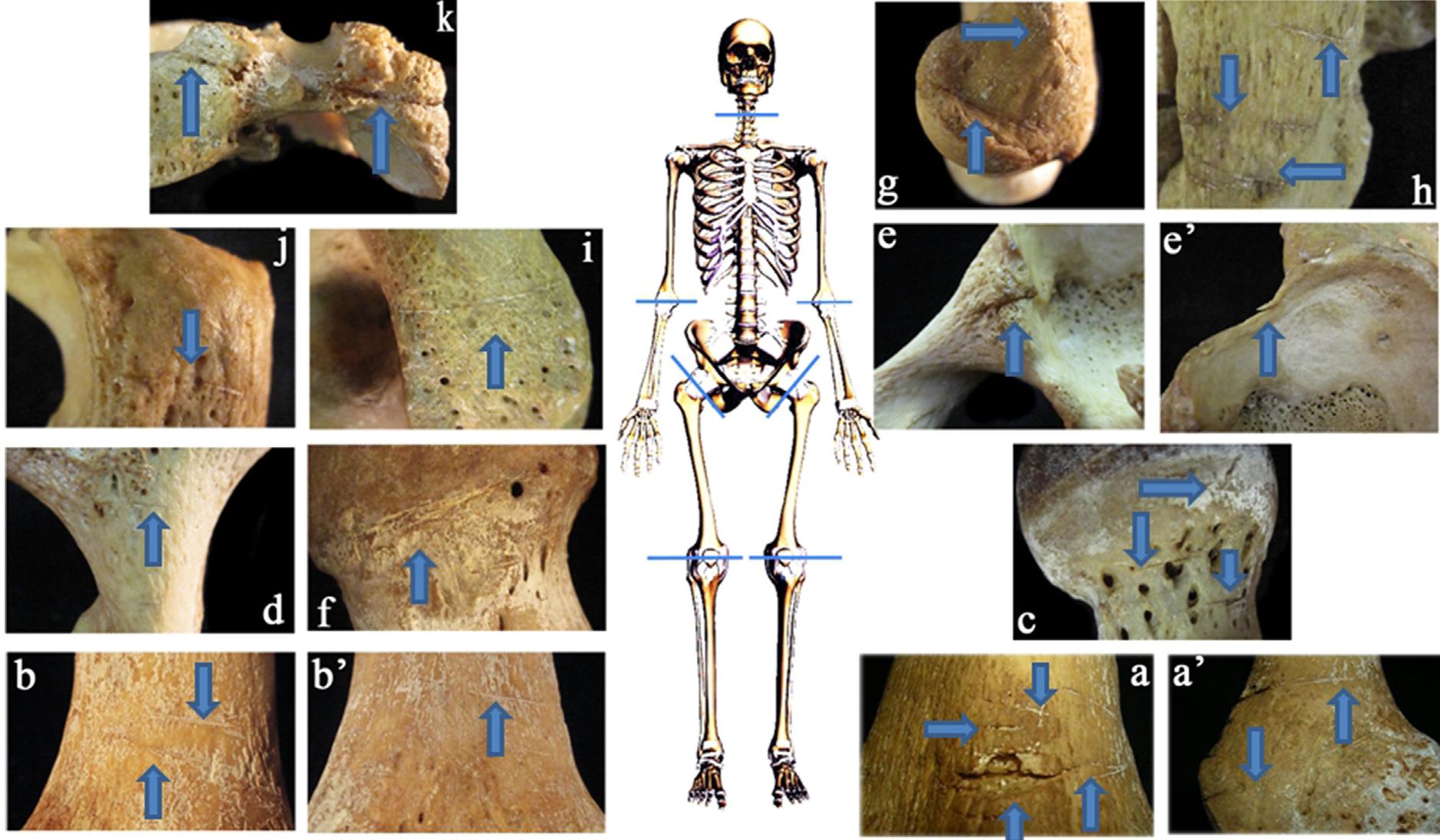 (PDF) Dismemberment and disarticulation: A forensic anthropological ...