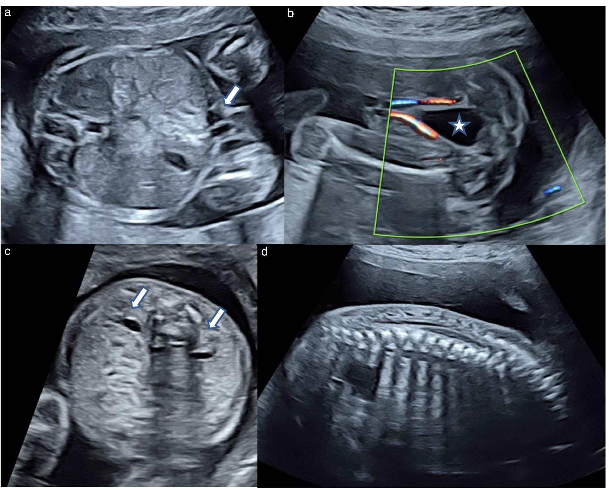 Ultrasound imaging of the fetal cord insertion site and